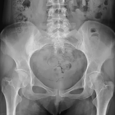 Endoscopic Hip Tendon Repair Chicago IL | Gluteus Medius Tendon Tears ...