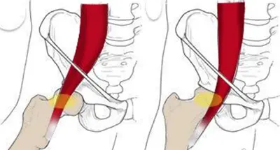 Endoscopic Hip Tendon Repair Chicago IL | Gluteus Medius Tendon Tears ...